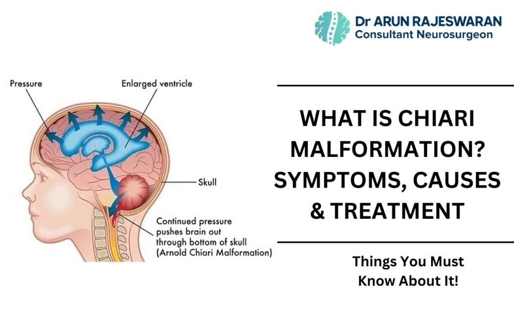 What Is Chiari Malformation? Symptoms, Causes & Treatment