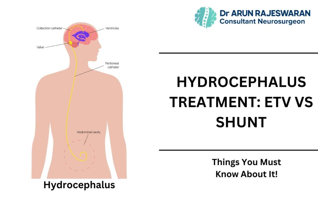 Hydrocephalus Treatment: ETV Vs Shunt