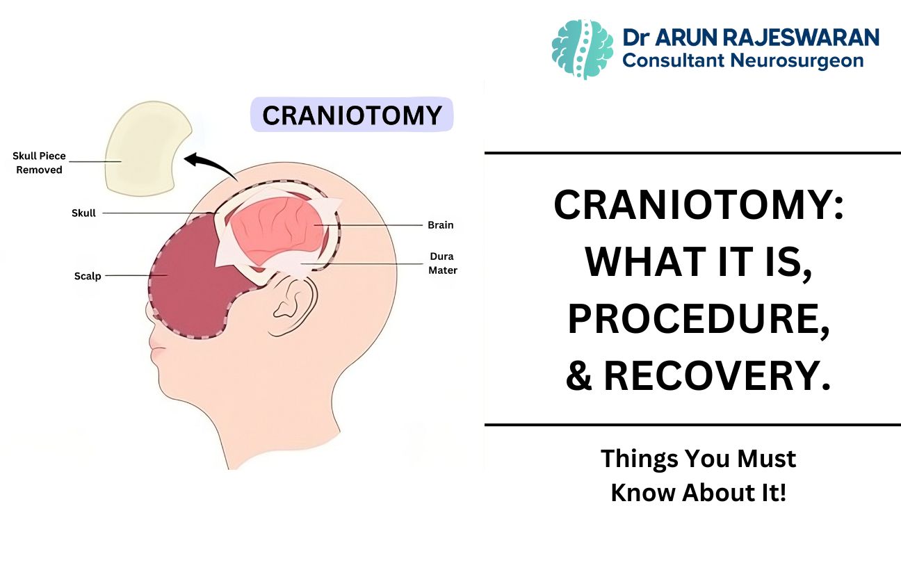 Craniotomy What It Is Procedure Recovery Craniotomy What It Is Procedure Recovery