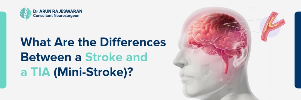 What Are the Differences Between a Stroke and a TIA (Mini-Stroke ...